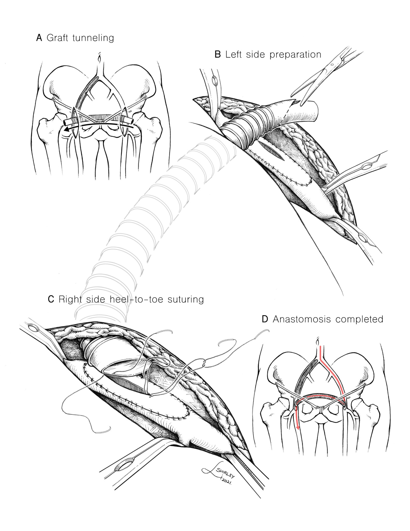 Femorofemoral Bypass – Shirley Li Studio
