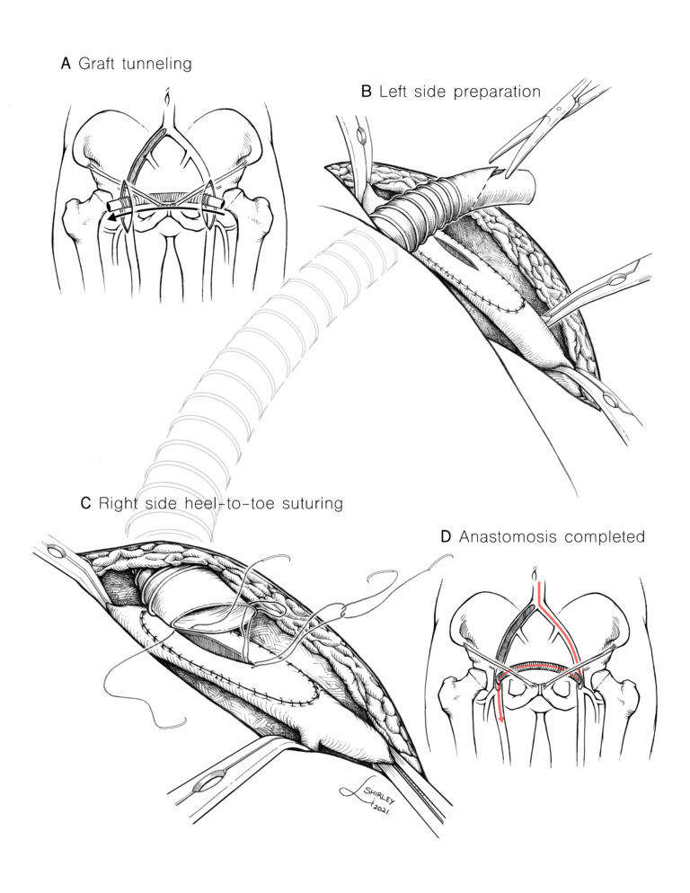 Femorofemoral Bypass – Shirley Li Studio